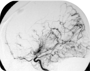 Moyamoya Disease - Macquarie Neurosurgery & Spine
