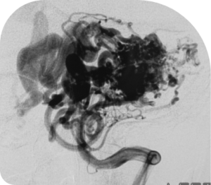 Arteriovenous Malformations - Macquarie Neurosurgery & Spine